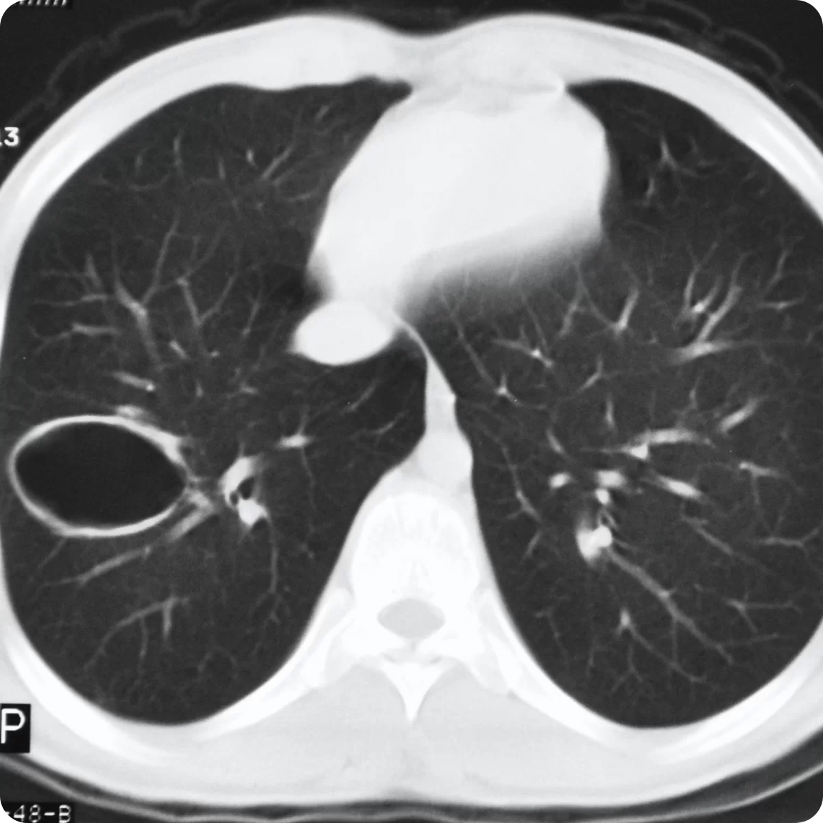 Quiste Hidatídico pulmonar - Cirugía Torácica Pediátrica