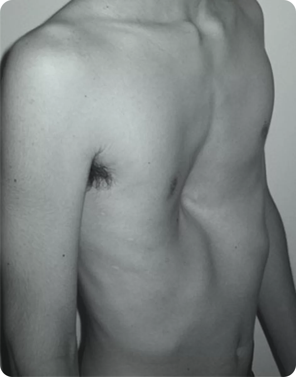 Pectus Excavatum: Tratamiento y Soluciones - Cirugía Torácica Pediátrica