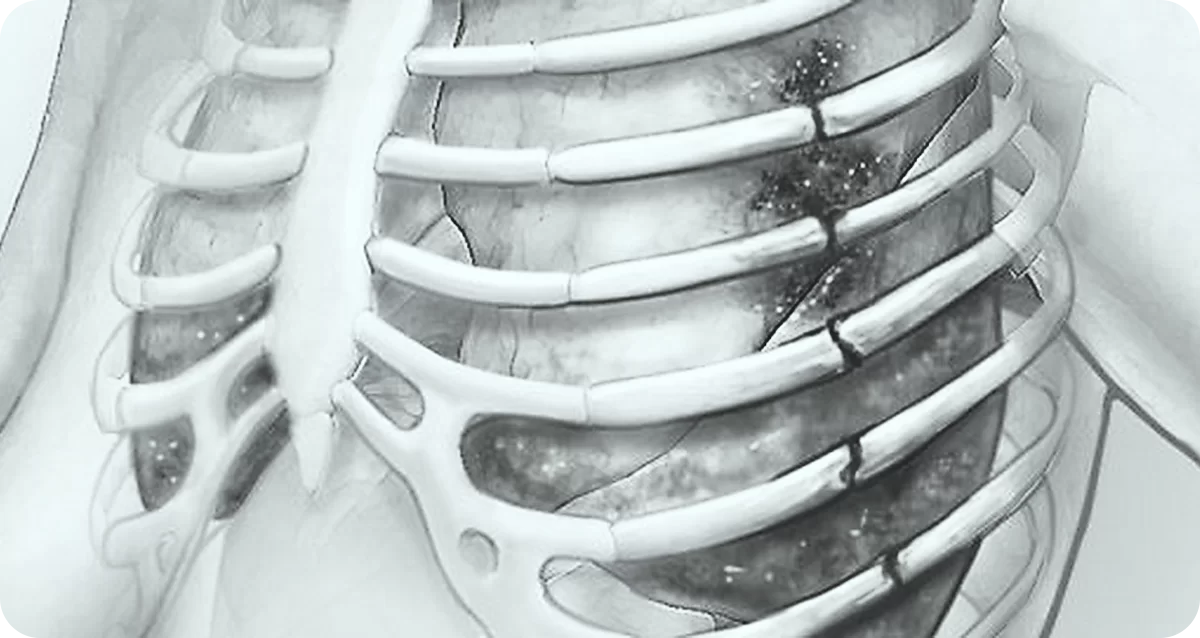 Traumatismo Torácico - Cirugía Torácica Pediátrica